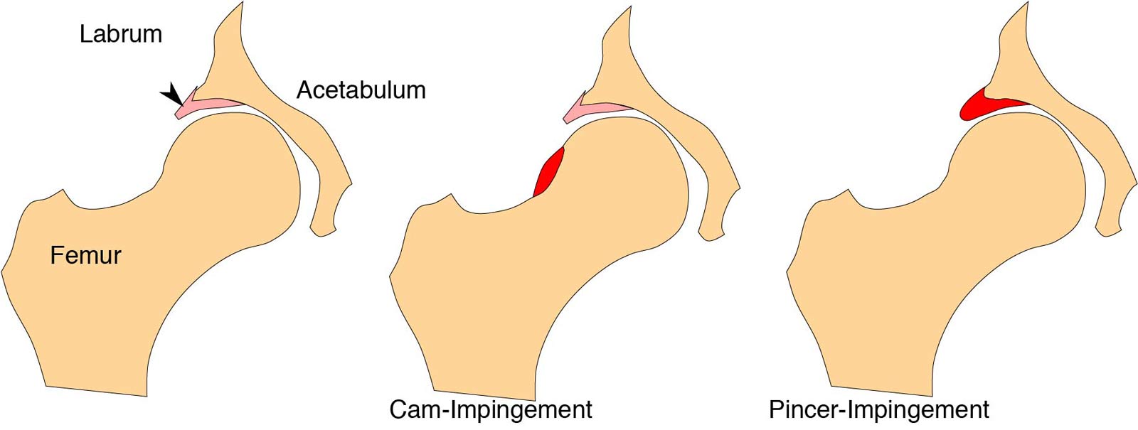 Heupscopie (kijkoperatie) - Eisenhower Kliniek