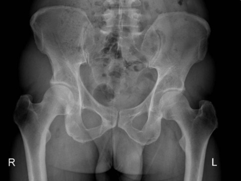 Diagnostiek bij heupklachten - Eisenhower Kliniek