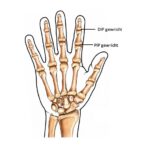 Artrose van de vinger gewrichten (PIP en DIP) - Eisenhower Kliniek