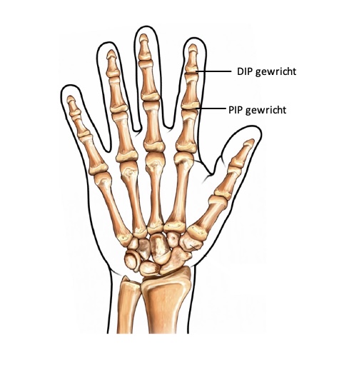 Artrose van de vinger gewrichten (PIP en DIP) - Eisenhower Kliniek