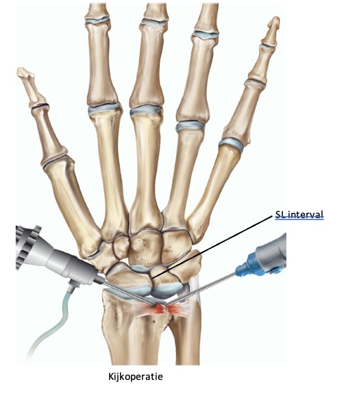 SL ruptuur - Eisenhower Kliniek