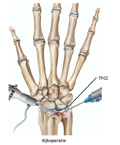 TFCC letsel - Eisenhower Kliniek